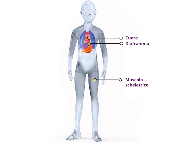 Distrofia muscolare di Duchenne (DMD) | Sarepta Therapeutics